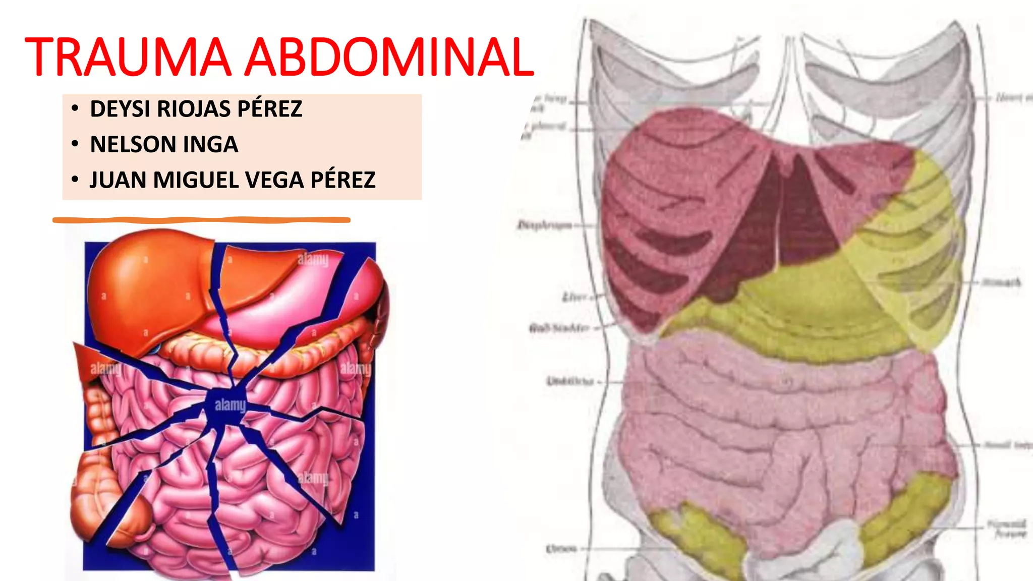 TRAUMA ABDOMINAL.pptx