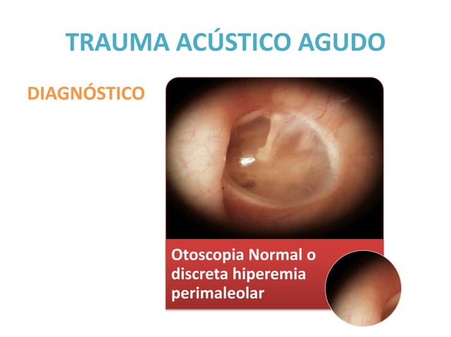 Trauma acustico agudo | PPTX | Ear, Nose and Throat Conditions ...
