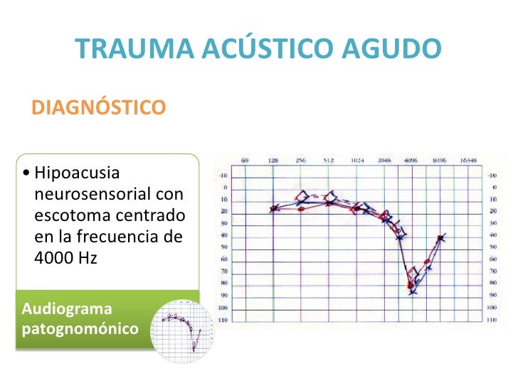 Trauma acustico agudo