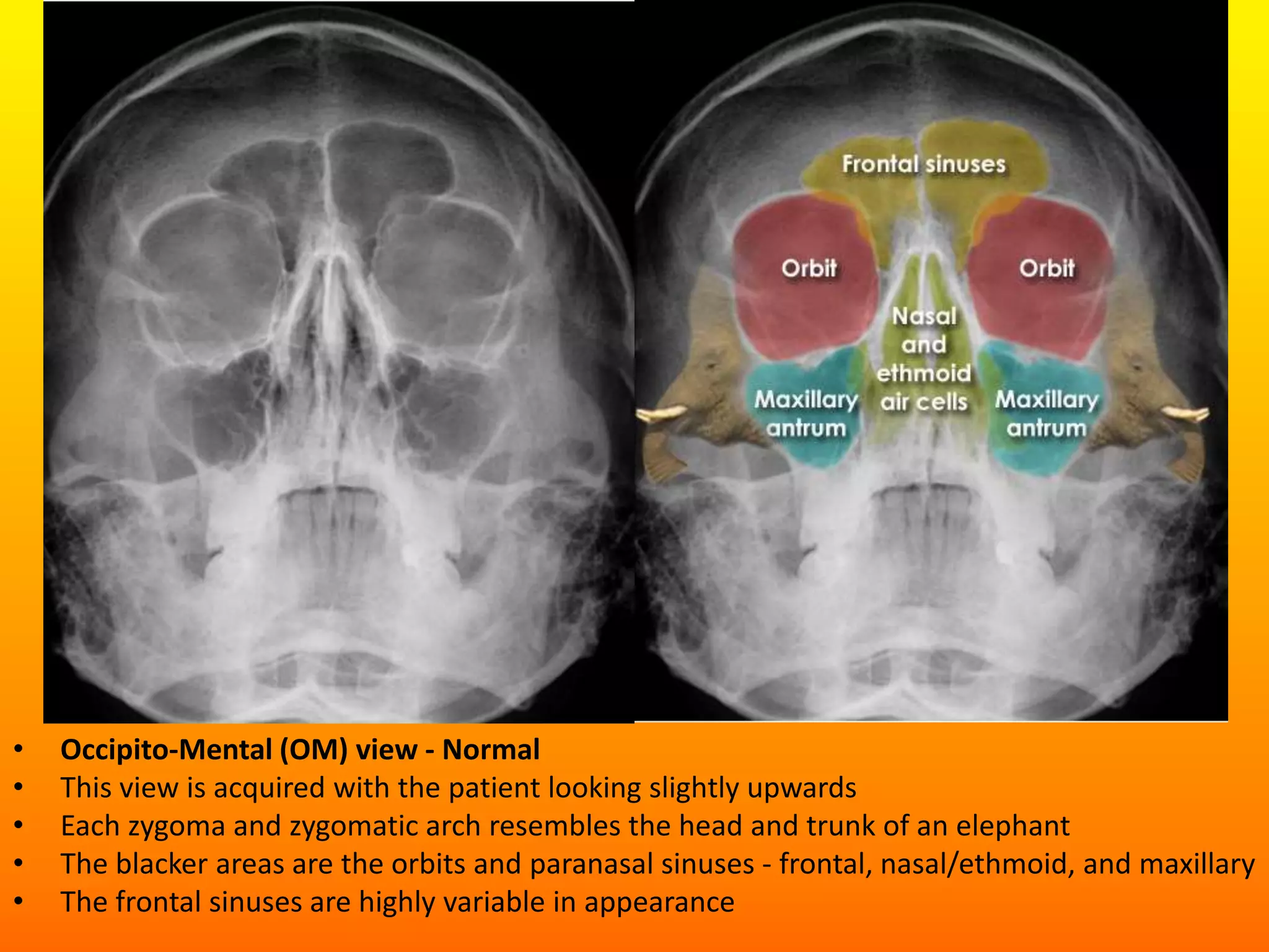 Trauma axial skeleton Dr. Muhammad Bin Zulfiqar | PPTX