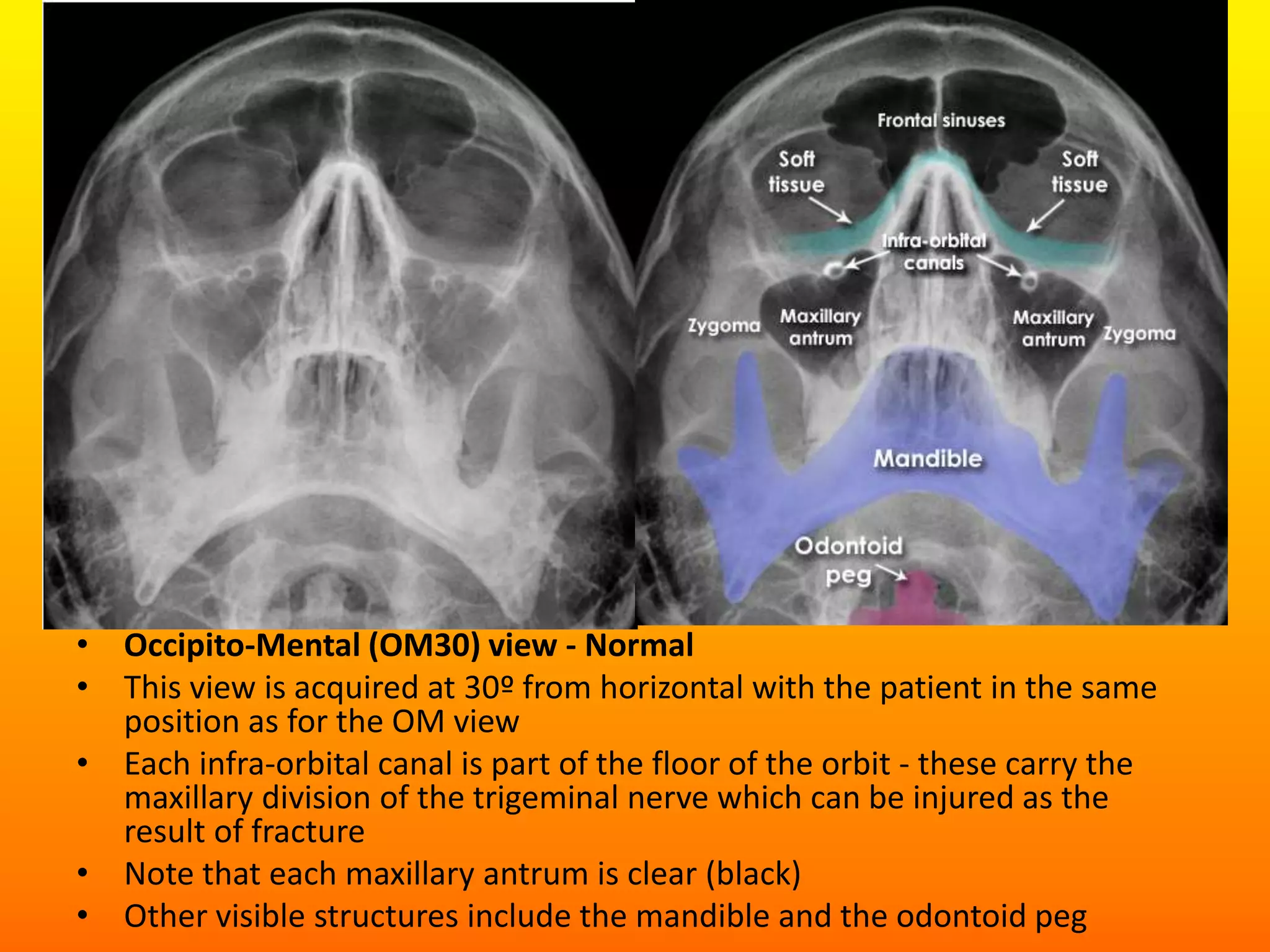 Trauma axial skeleton Dr. Muhammad Bin Zulfiqar | PPTX