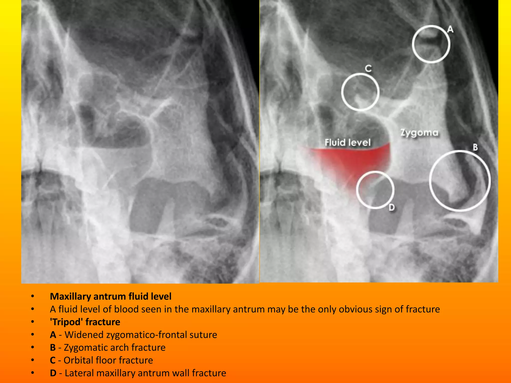 Trauma axial skeleton Dr. Muhammad Bin Zulfiqar | PPTX