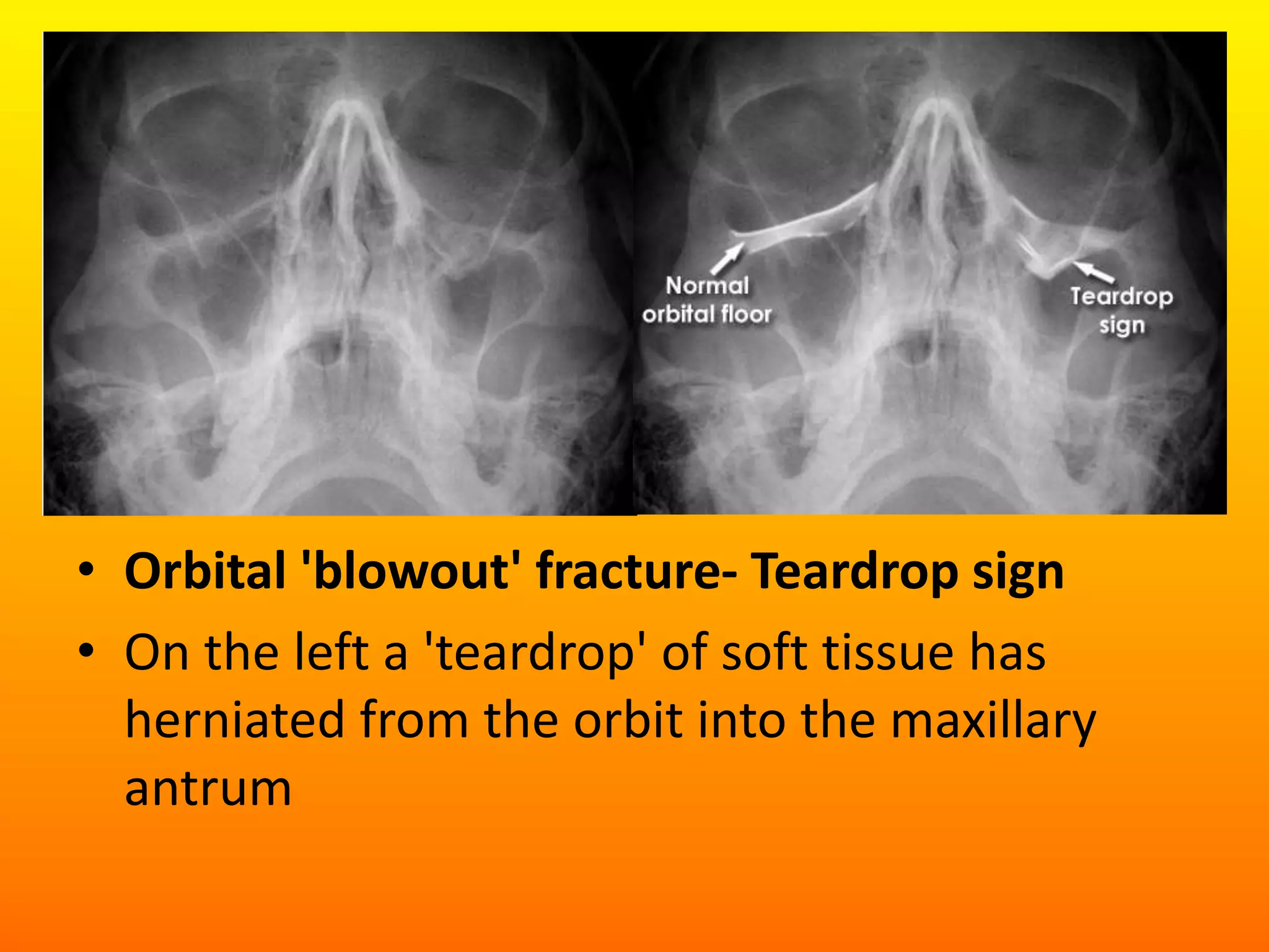 Trauma axial skeleton Dr. Muhammad Bin Zulfiqar | PPTX
