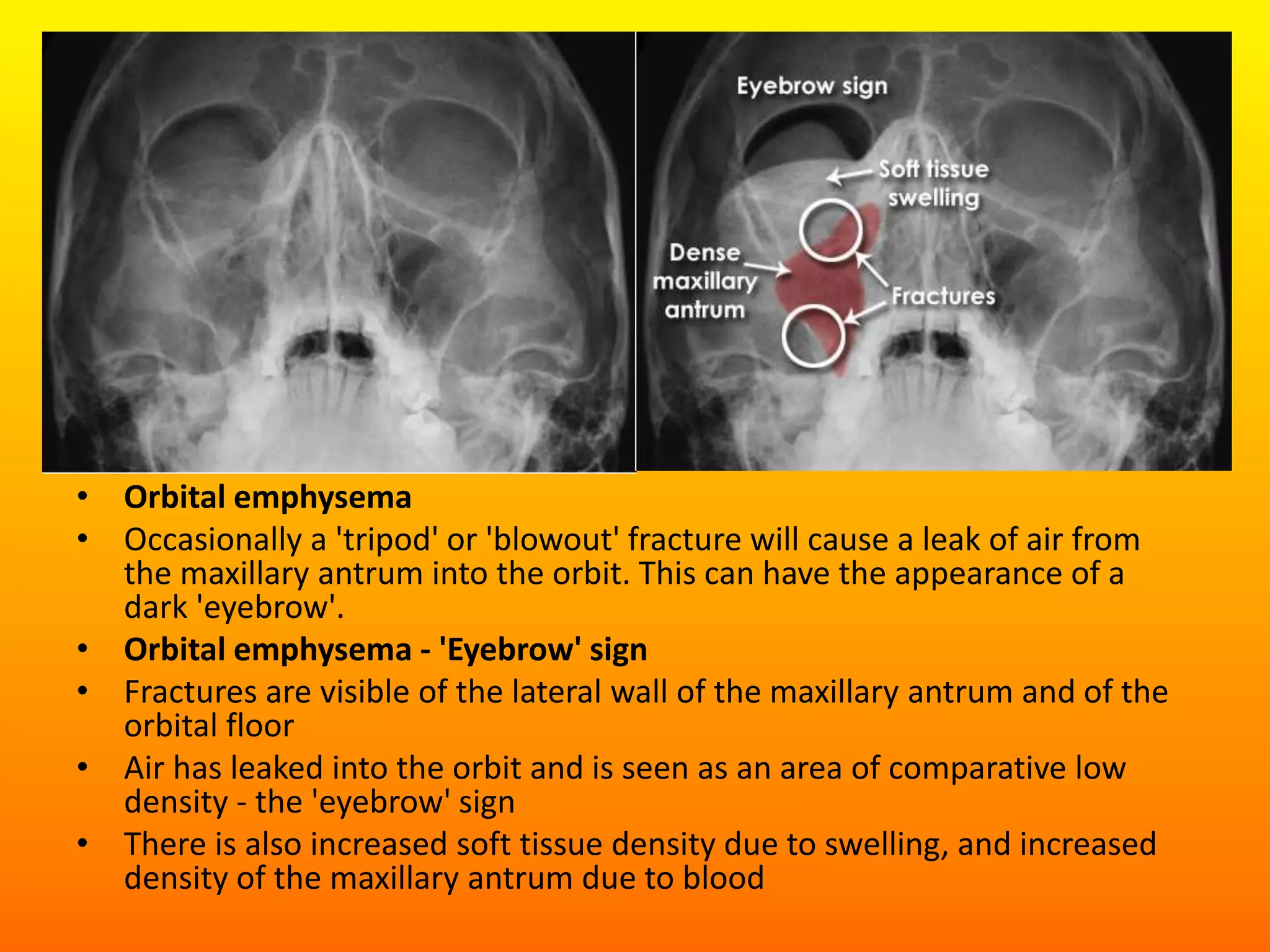 Trauma axial skeleton Dr. Muhammad Bin Zulfiqar | PPTX