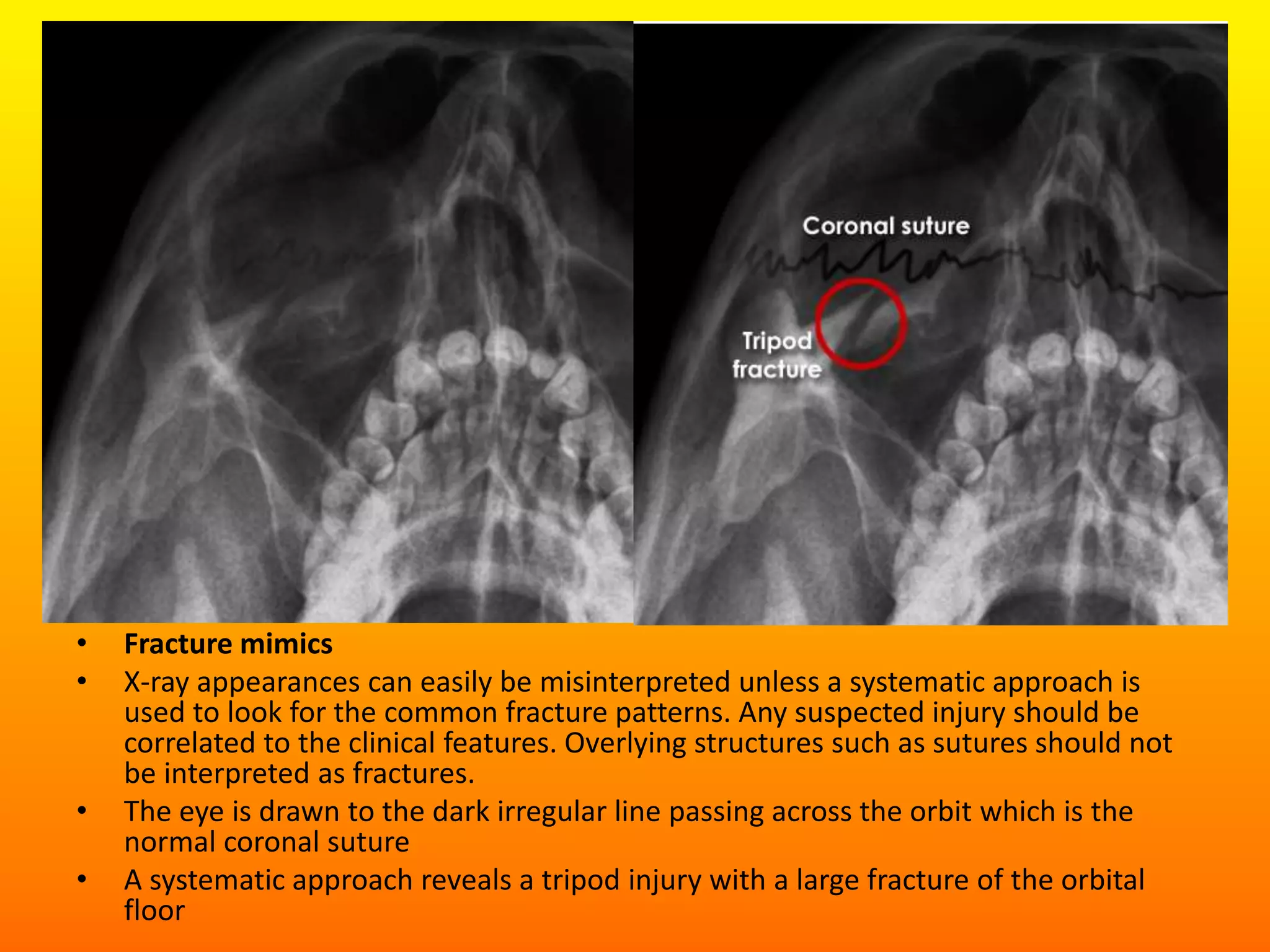Trauma axial skeleton Dr. Muhammad Bin Zulfiqar | PPTX