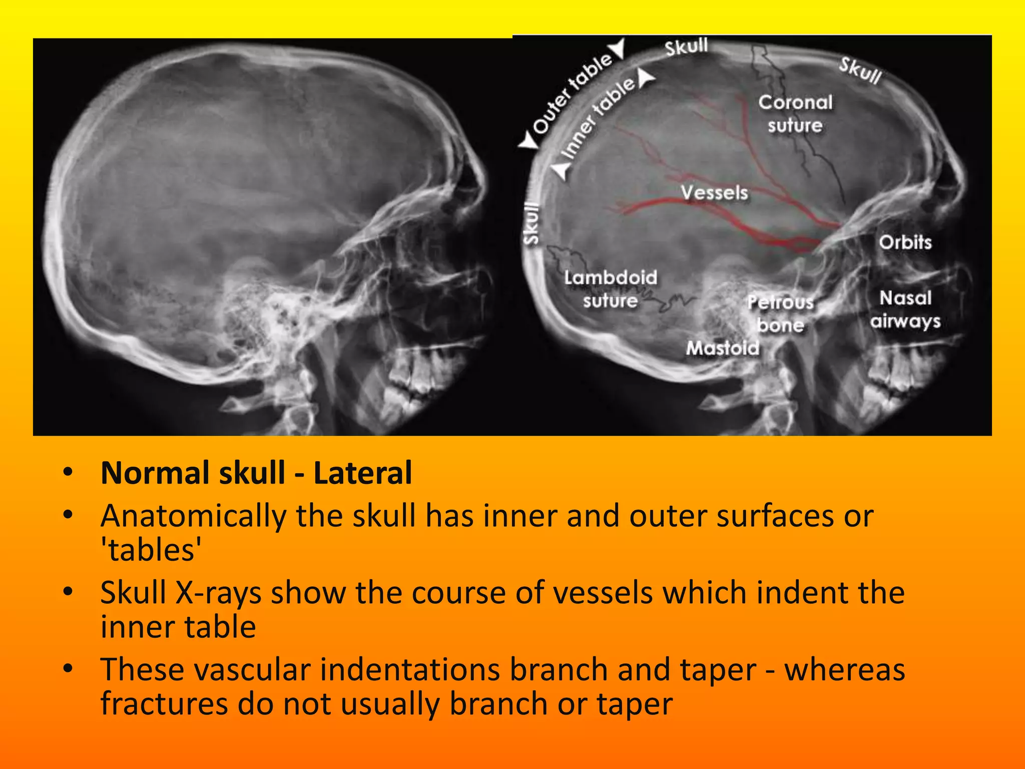 Trauma axial skeleton Dr. Muhammad Bin Zulfiqar | PPTX
