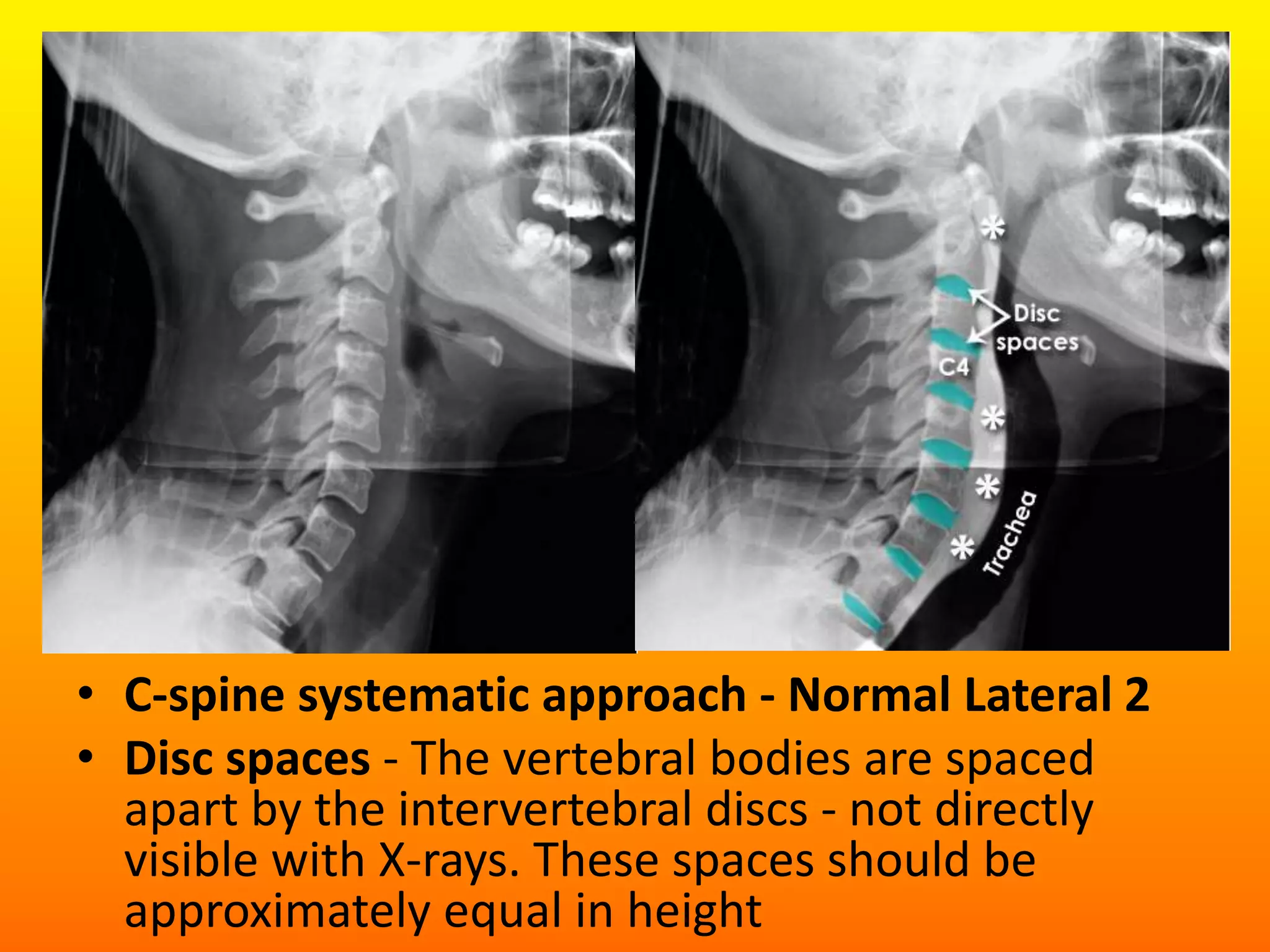 Trauma axial skeleton Dr. Muhammad Bin Zulfiqar | PPTX