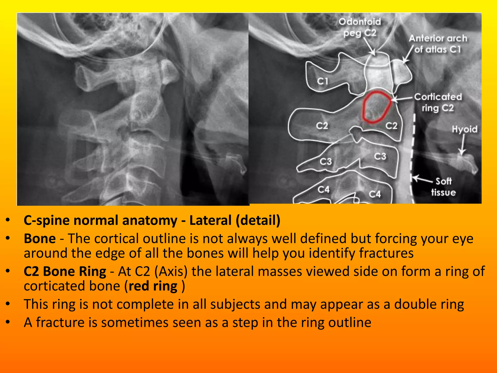 Trauma axial skeleton Dr. Muhammad Bin Zulfiqar | PPTX