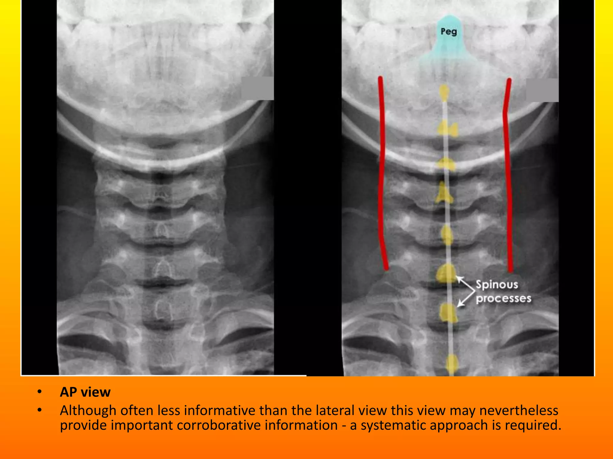 Trauma axial skeleton Dr. Muhammad Bin Zulfiqar | PPTX