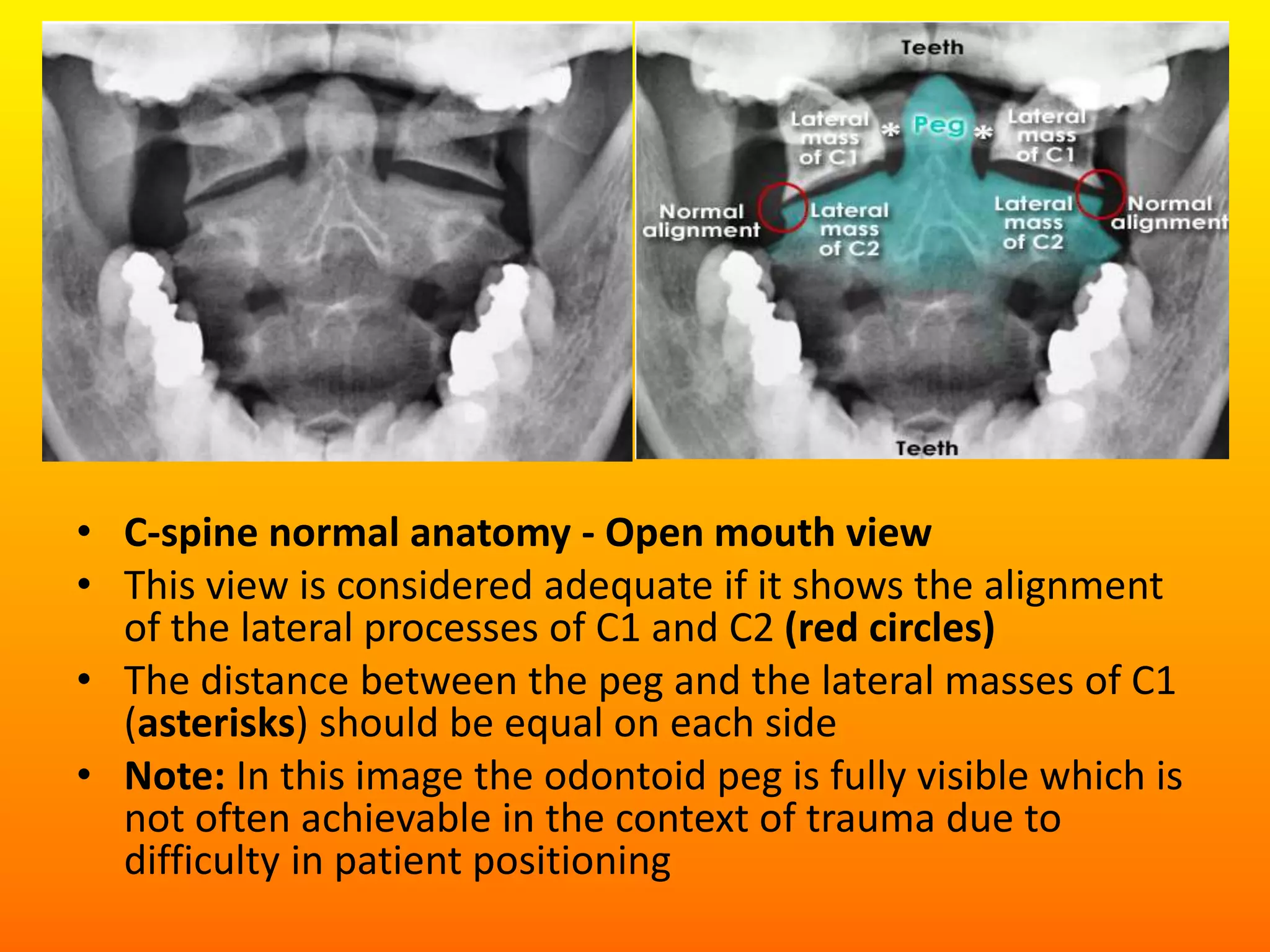 Trauma axial skeleton Dr. Muhammad Bin Zulfiqar | PPTX