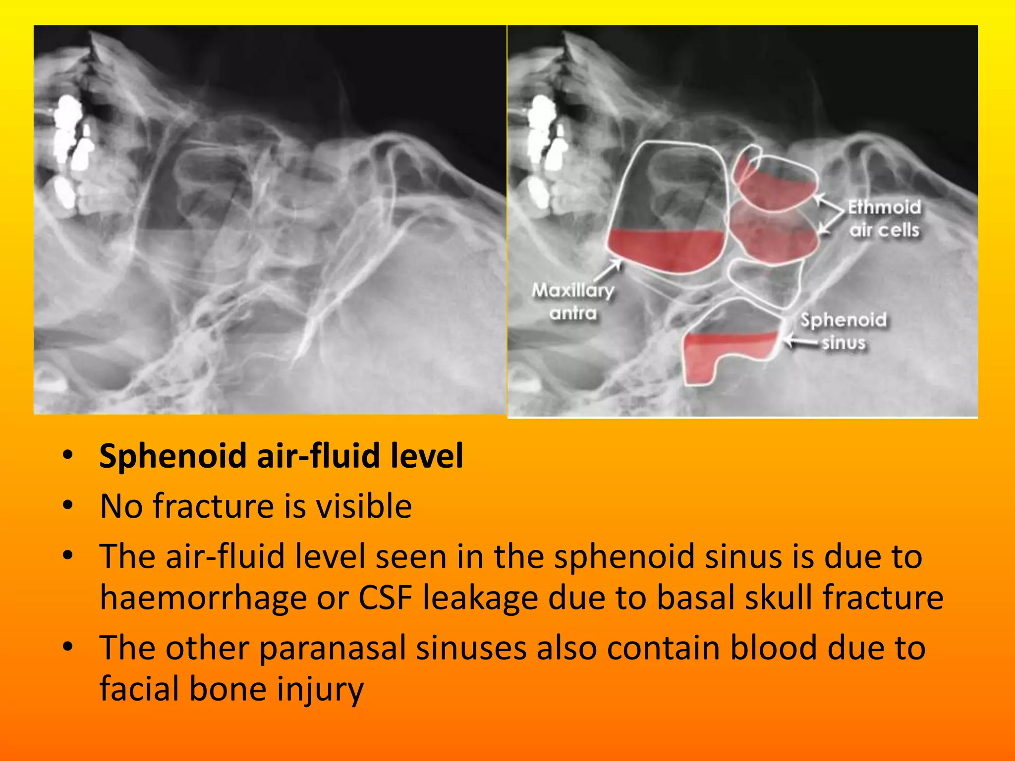 Trauma axial skeleton Dr. Muhammad Bin Zulfiqar | PPTX
