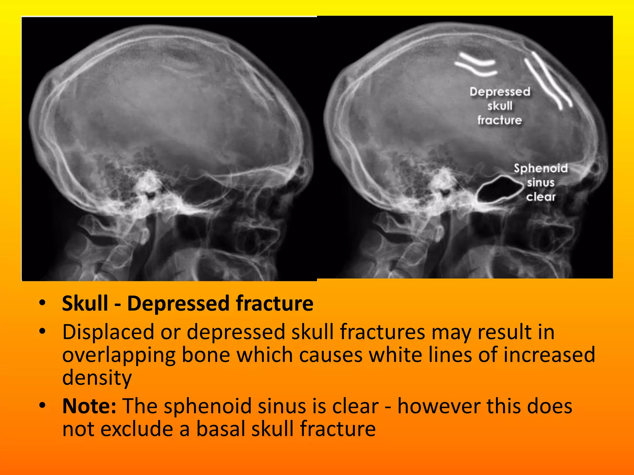 Trauma axial skeleton Dr. Muhammad Bin Zulfiqar | PPTX