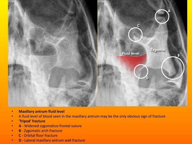 Trauma axial skeleton Dr. Muhammad Bin Zulfiqar | PPT