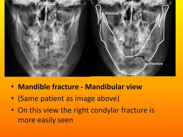 Trauma axial skeleton Dr. Muhammad Bin Zulfiqar | PPT
