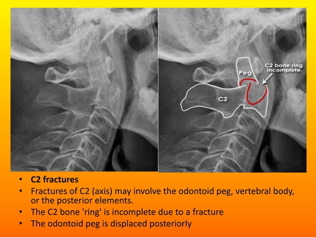 Trauma axial skeleton Dr. Muhammad Bin Zulfiqar | PPT
