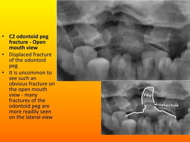 Trauma axial skeleton Dr. Muhammad Bin Zulfiqar | PPT