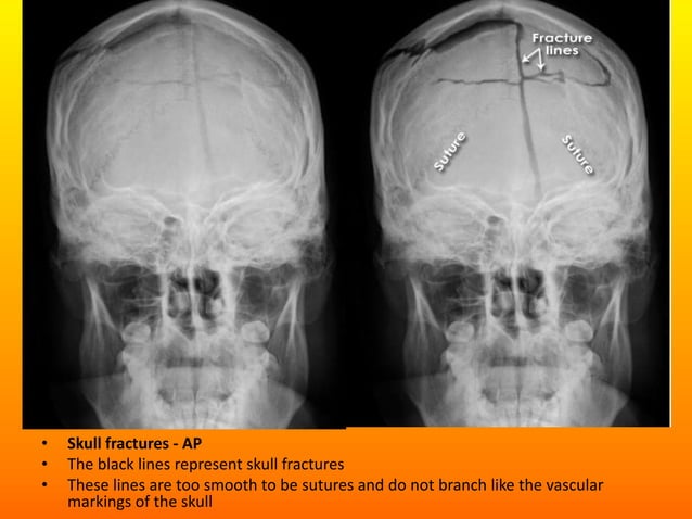 Trauma axial skeleton Dr. Muhammad Bin Zulfiqar | PPT