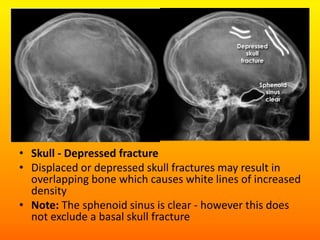 Basilar Skull Fracture X Ray