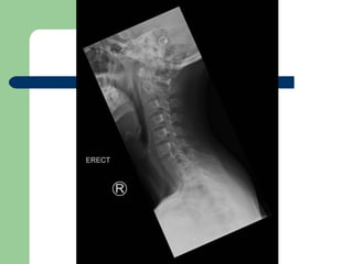Spinal Trauma: The Legend of the C-Spine Collar - A Case Report | PPT