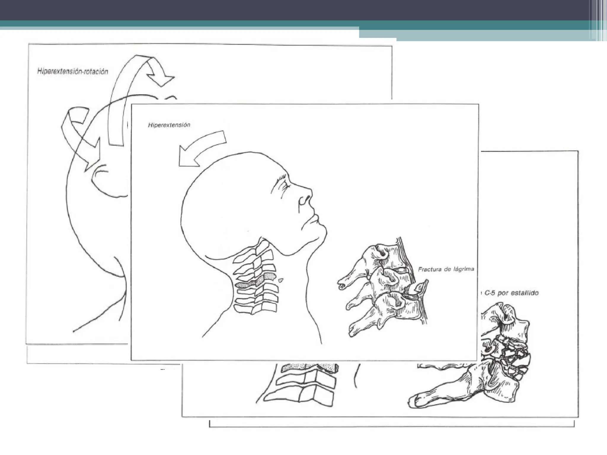 trauma de cervical axial y subaxial.ppt