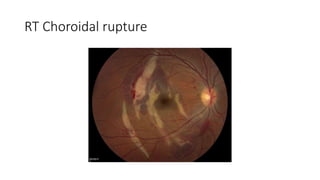 Ahmed Osama Hashem ophthalmology Trauma clinical slides | PPT