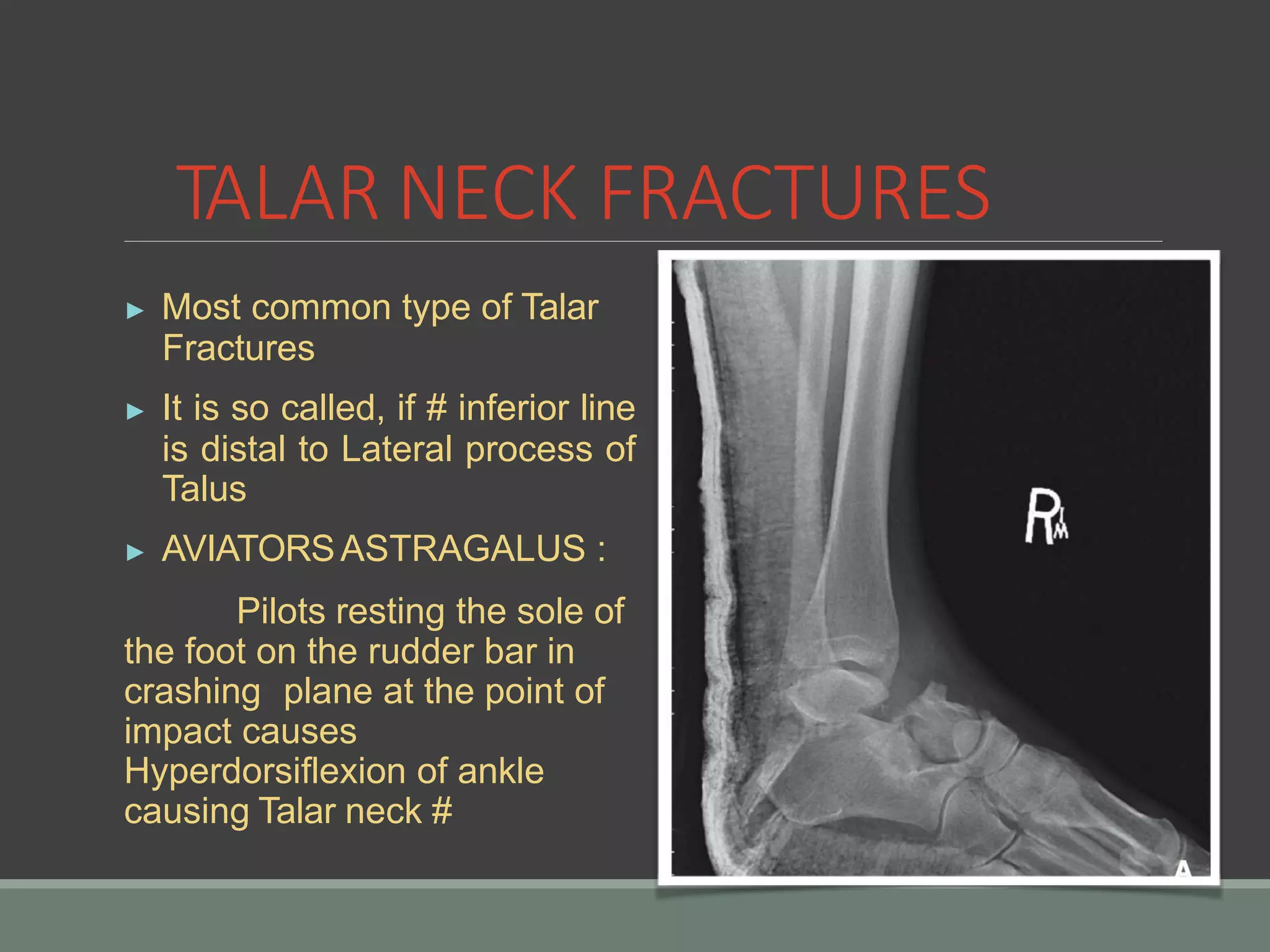 TRAUMA CON-TALAR FRACTURES.pptx