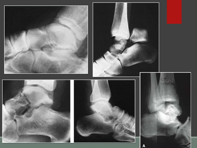 TRAUMA CON-TALAR FRACTURES.pptx
