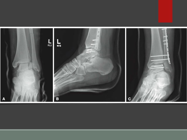 TRAUMA CON-TALAR FRACTURES.pptx