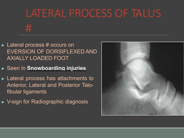 TRAUMA CON-TALAR FRACTURES.pptx