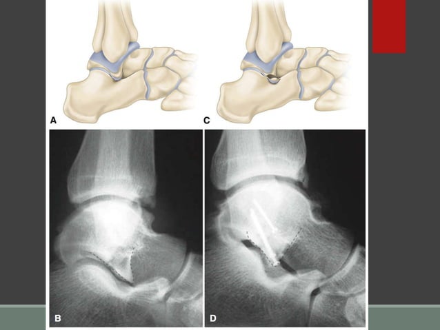TRAUMA CON-TALAR FRACTURES.pptx