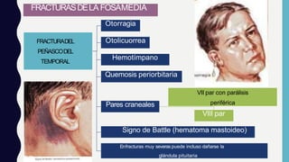 Trauma craneoencefalico Isbelle.pptx