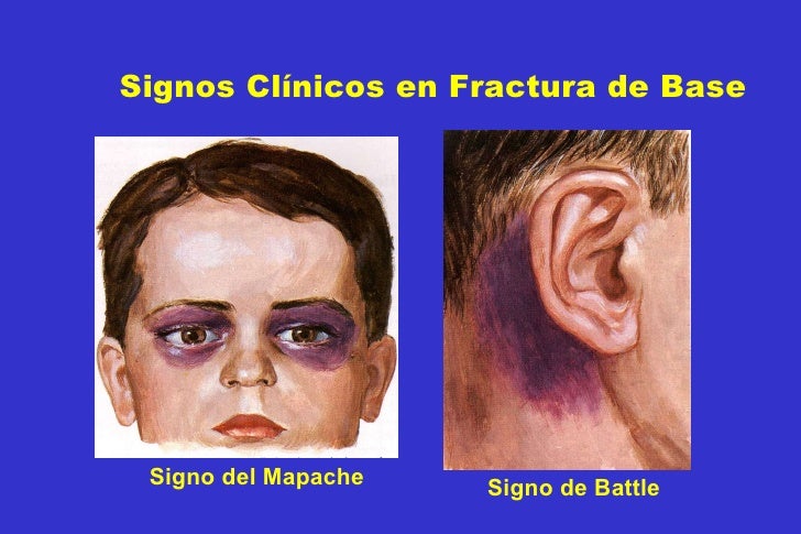 Trauma craneoencefálico