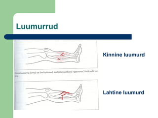 Traumad. PõRutused, Nikastus, Nihestus, Luumurrud | PPT