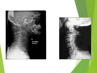 Trauma de columna y medula espinal ATLS | PPTX