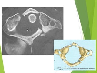 Trauma de columna y medula espinal ATLS | PPTX