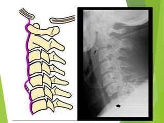 Trauma de columna y medula espinal ATLS | PPTX