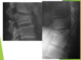 Trauma de columna y medula espinal ATLS | PPTX