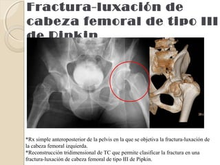 Trauma de femur | PPT
