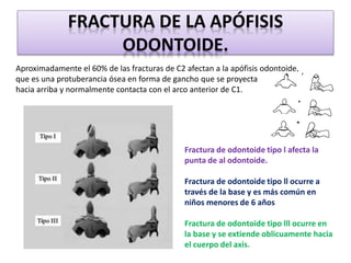Trauma de la columna vertebral y medula espinal. | PPTX