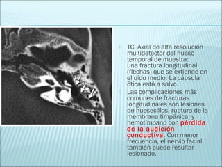 Trauma del hueso temporal y el papel de | PPT