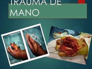 Trauma de mano terminado | PPTX