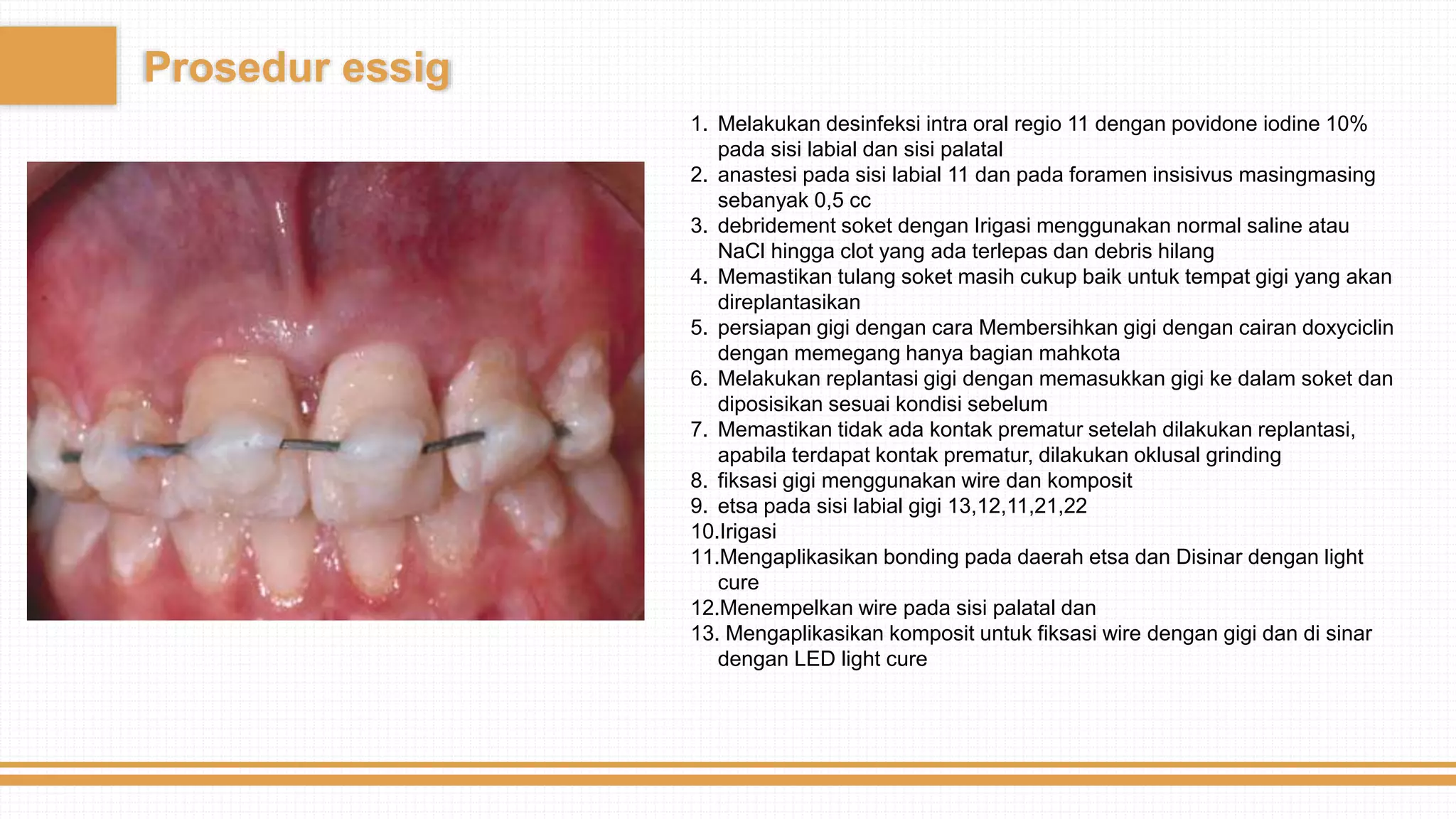 Trauma dentoalveolar | PPTX