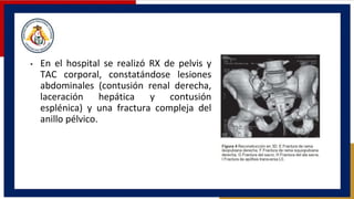 TRAUMA DE PELVIS Y EXTREMIDADES.pptx