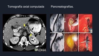Trauma de páncreas.pptx