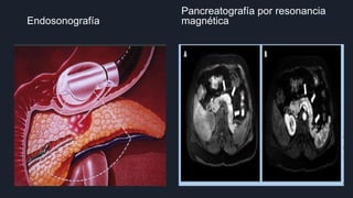 Trauma de páncreas.pptx
