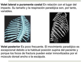 Trauma de torax | PPTX