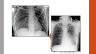 Trauma de torax | PPTX