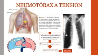 Trauma de torax | PPTX