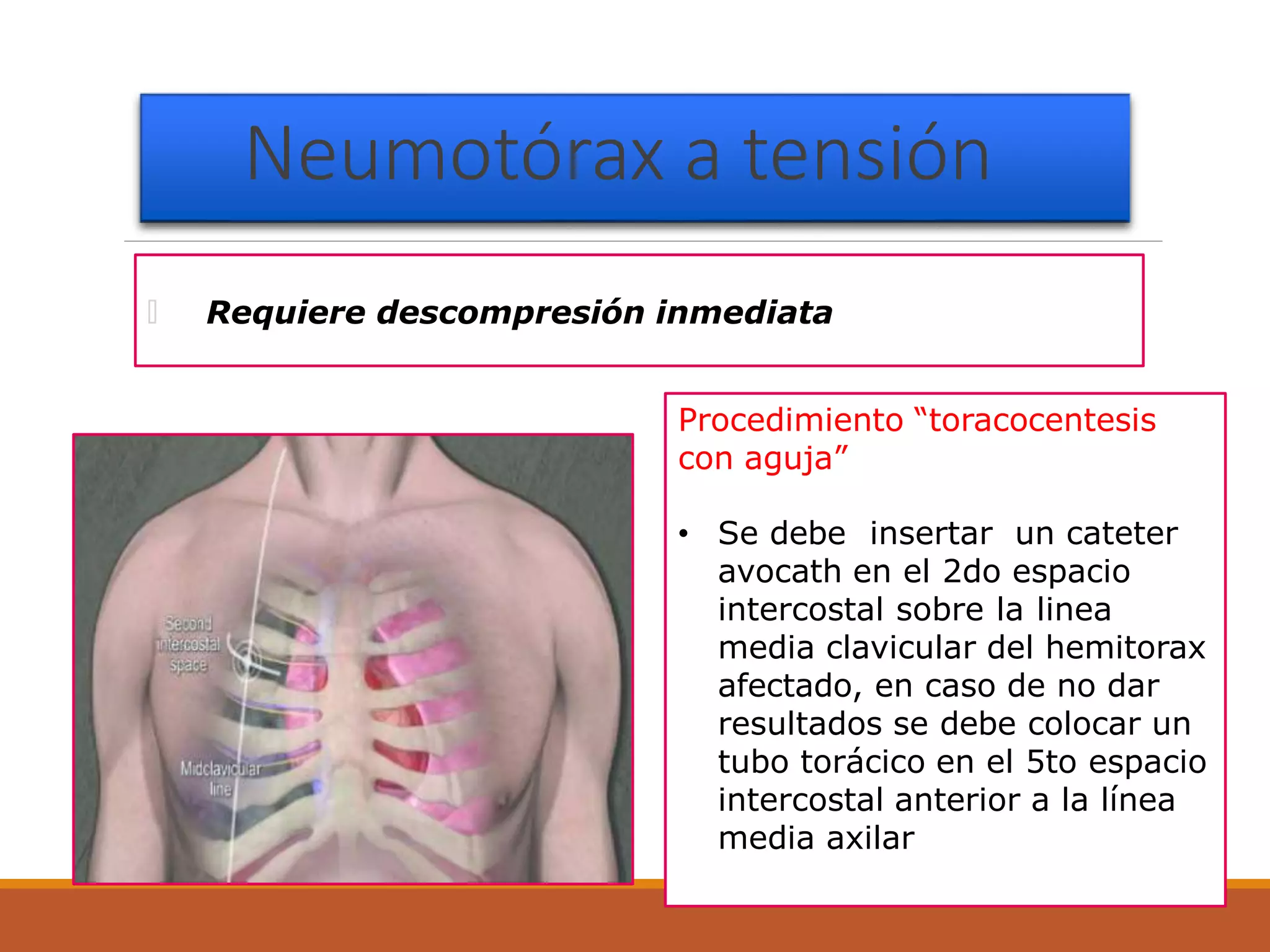Trauma de torax | PPTX