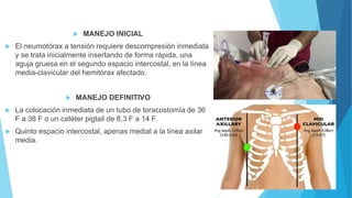 TRAUMA DE TORAX.pptx